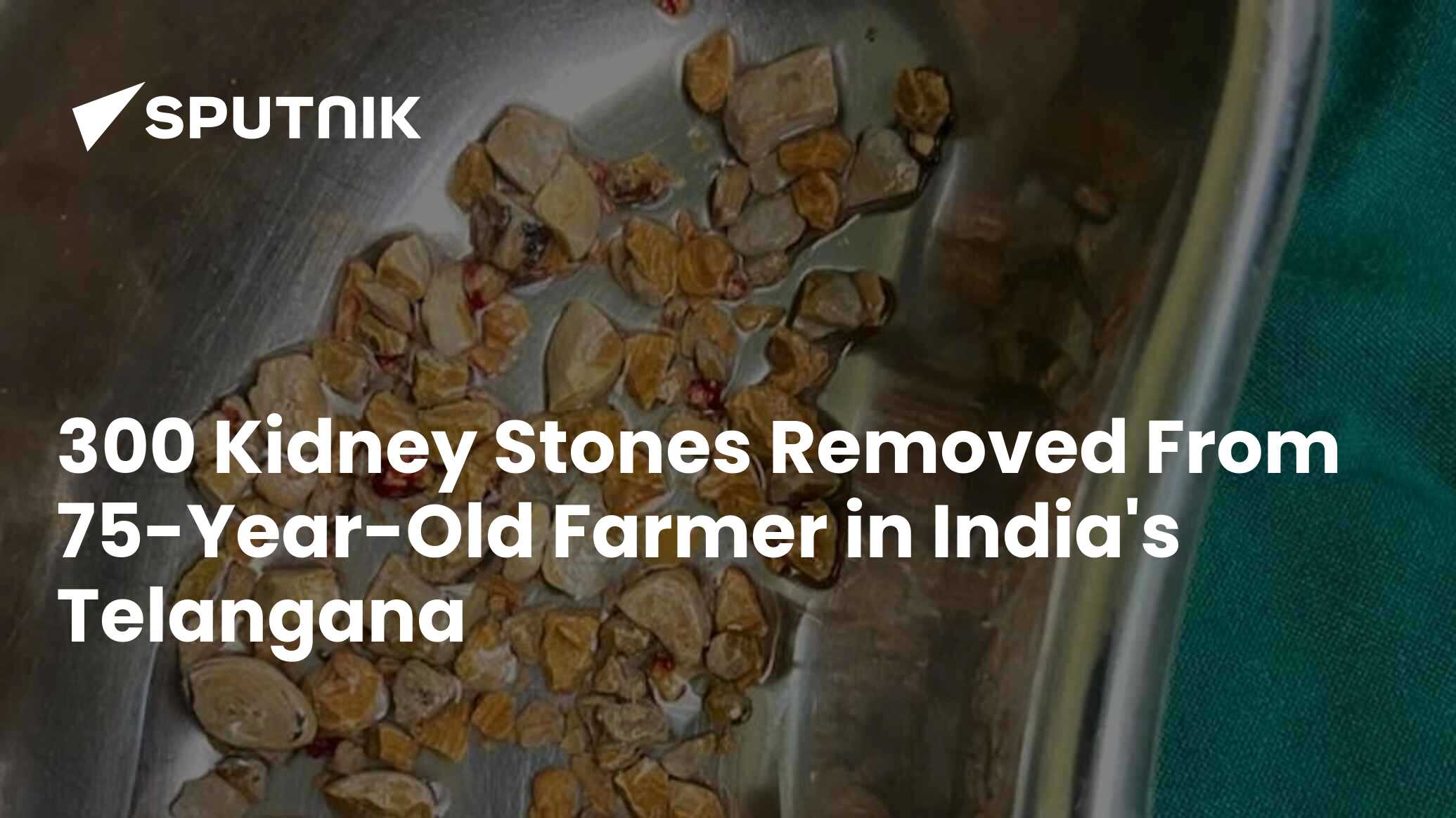 300 Kidney Stones Removed from 75-Year-Old Farmer in India's Telangana